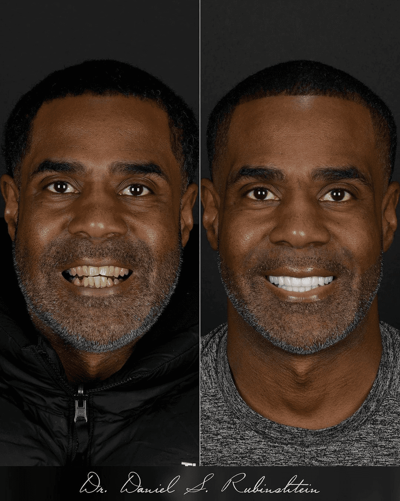 Smile Makeovers | Before & After Photos | Bensonhurst Dental
