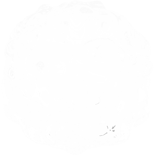 Intravascular Lithotripsy (IVL) Catheters | FastWave Medical