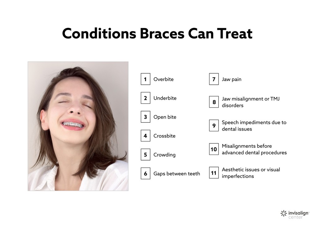 Braces: Types, How They Work, Care, Cost, and Results