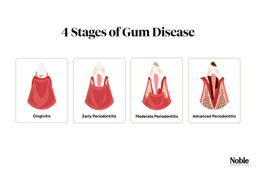 Gum Disease in Dogs: Stages, Causes, and Treatment