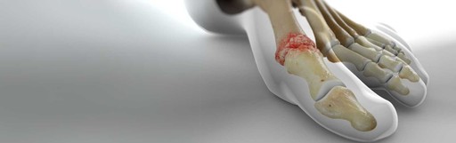 First MTP Cheilectomy Surgery | PathWay Surgical Team