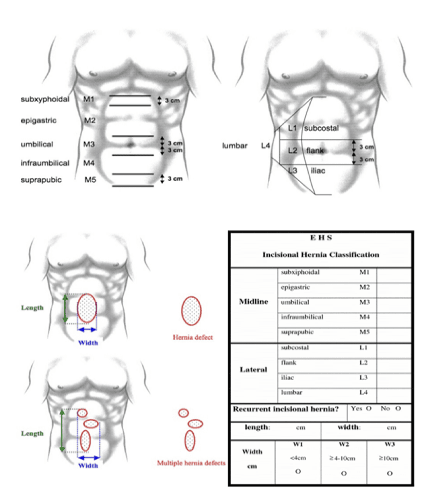 Best Hernia Surgery in Delhi, India | Dr. Aloy Mukherjee