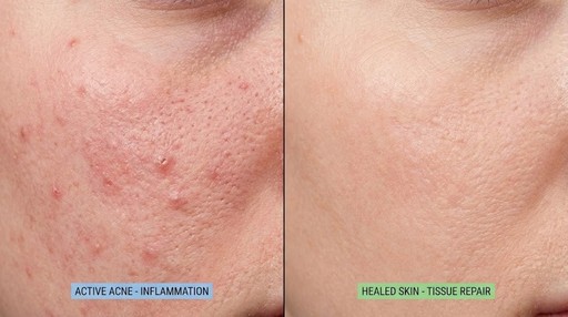Peptides for acne: the complete guide to clearer skin - SeekPeptides