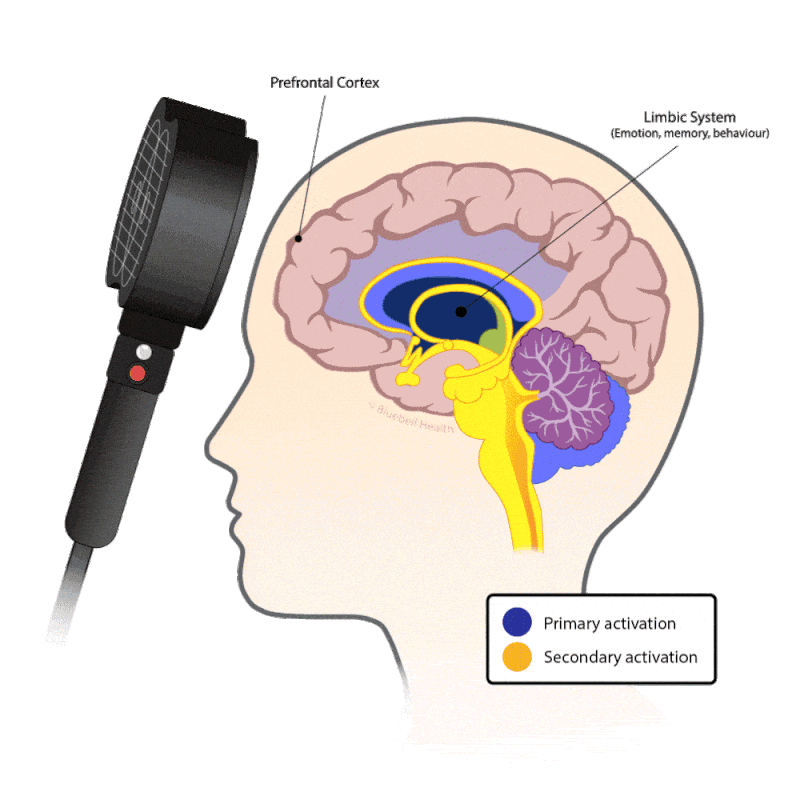 What Is TMS - Bluebell Health