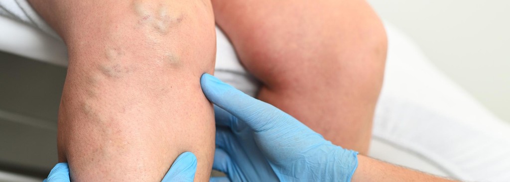 Understanding Chronic Venous Insufficiency: Signs, Risks, and ...