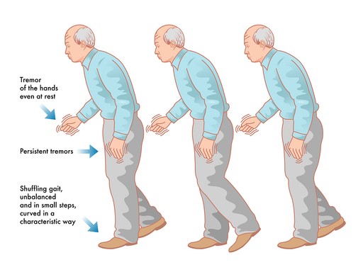 Understanding the On and Off Phases in Parkinson’s Disease - PRS ...