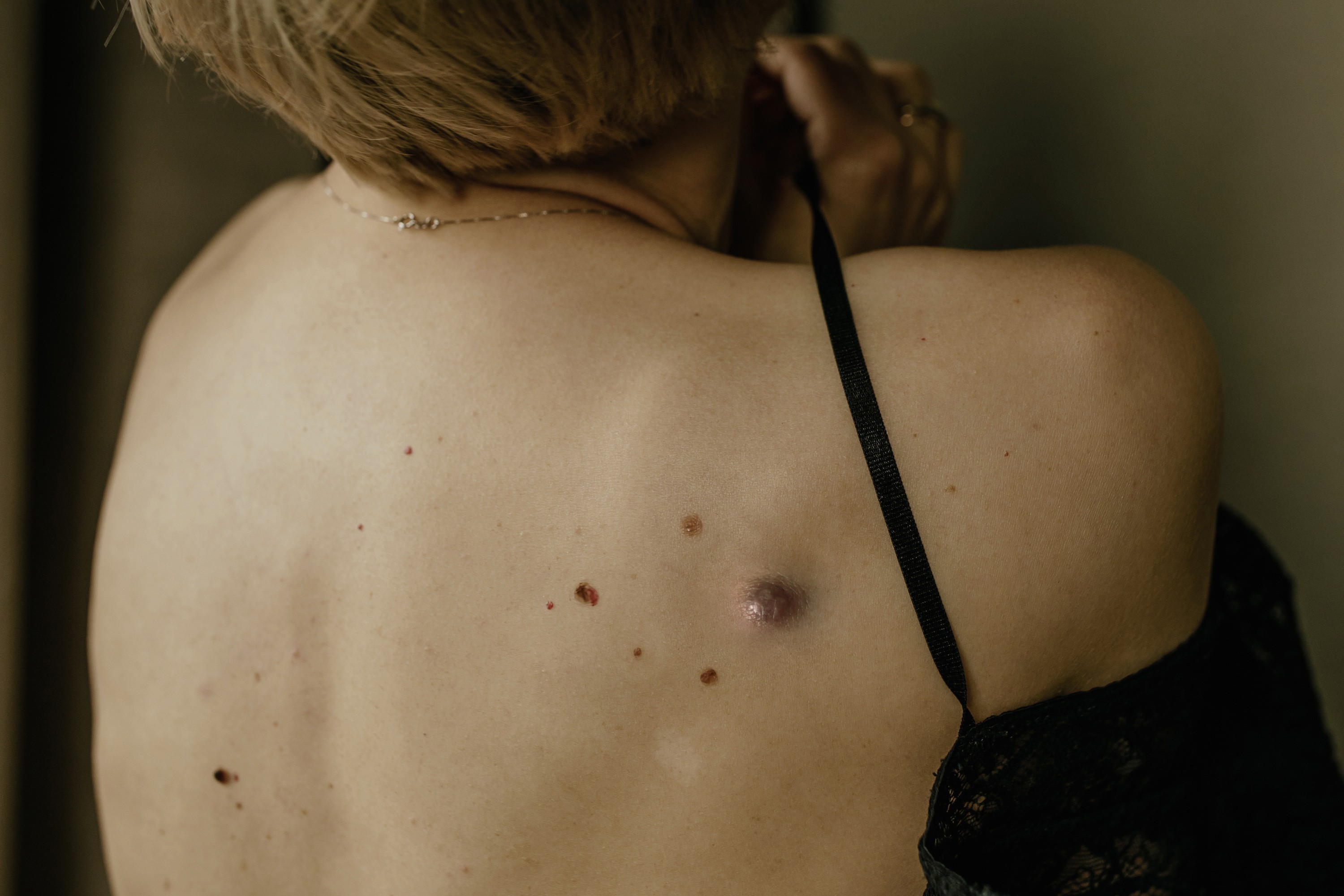 Mole Mapping in Eastbourne | Irresistible Skin Clinic