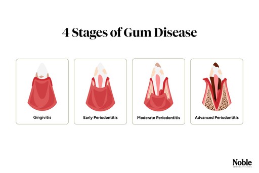 Gum Disease in Dogs: Stages, Causes, and Treatment
