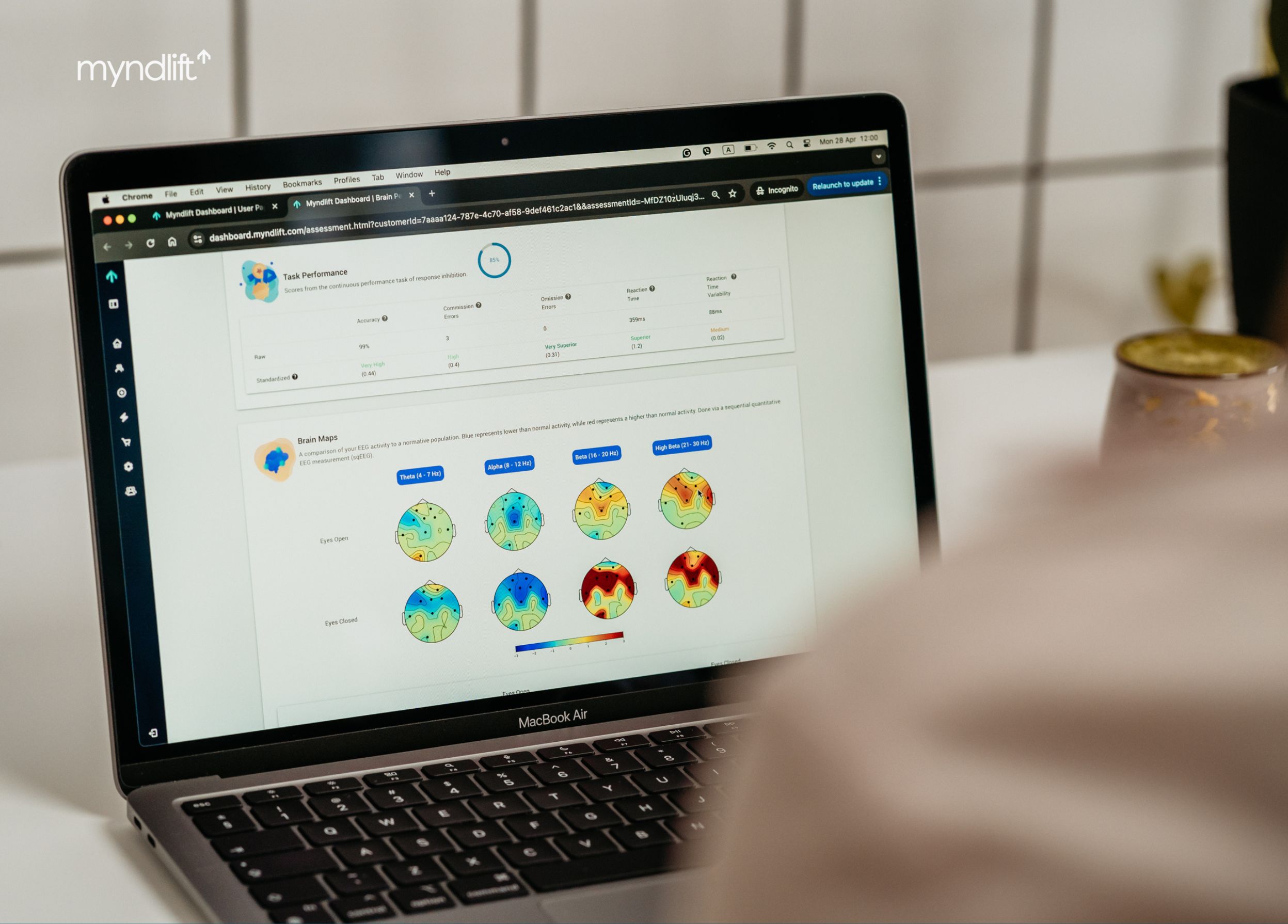 How to Read a qEEG Brain Map: A Practical Guide