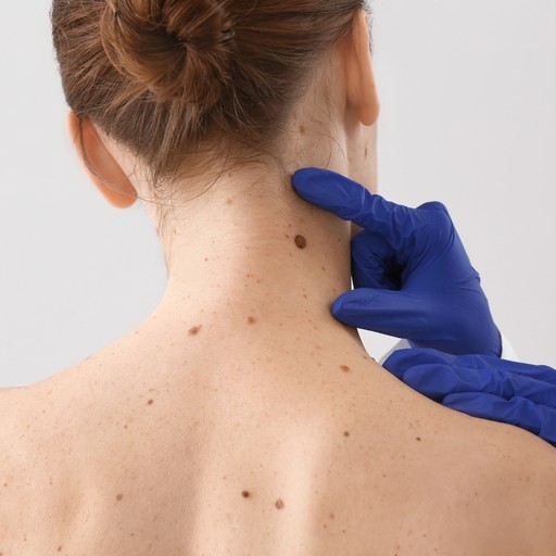 Full Body Mole Mapping | Montrose London
