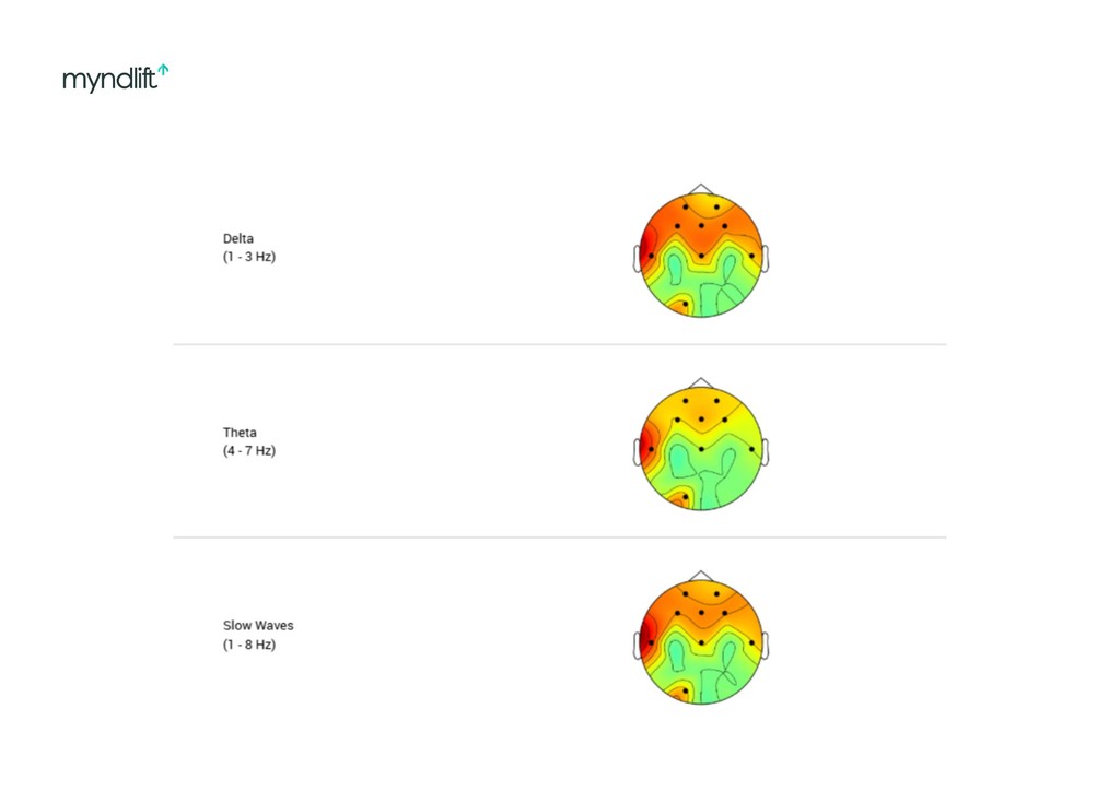 How to Read a qEEG Brain Map: A Practical Guide