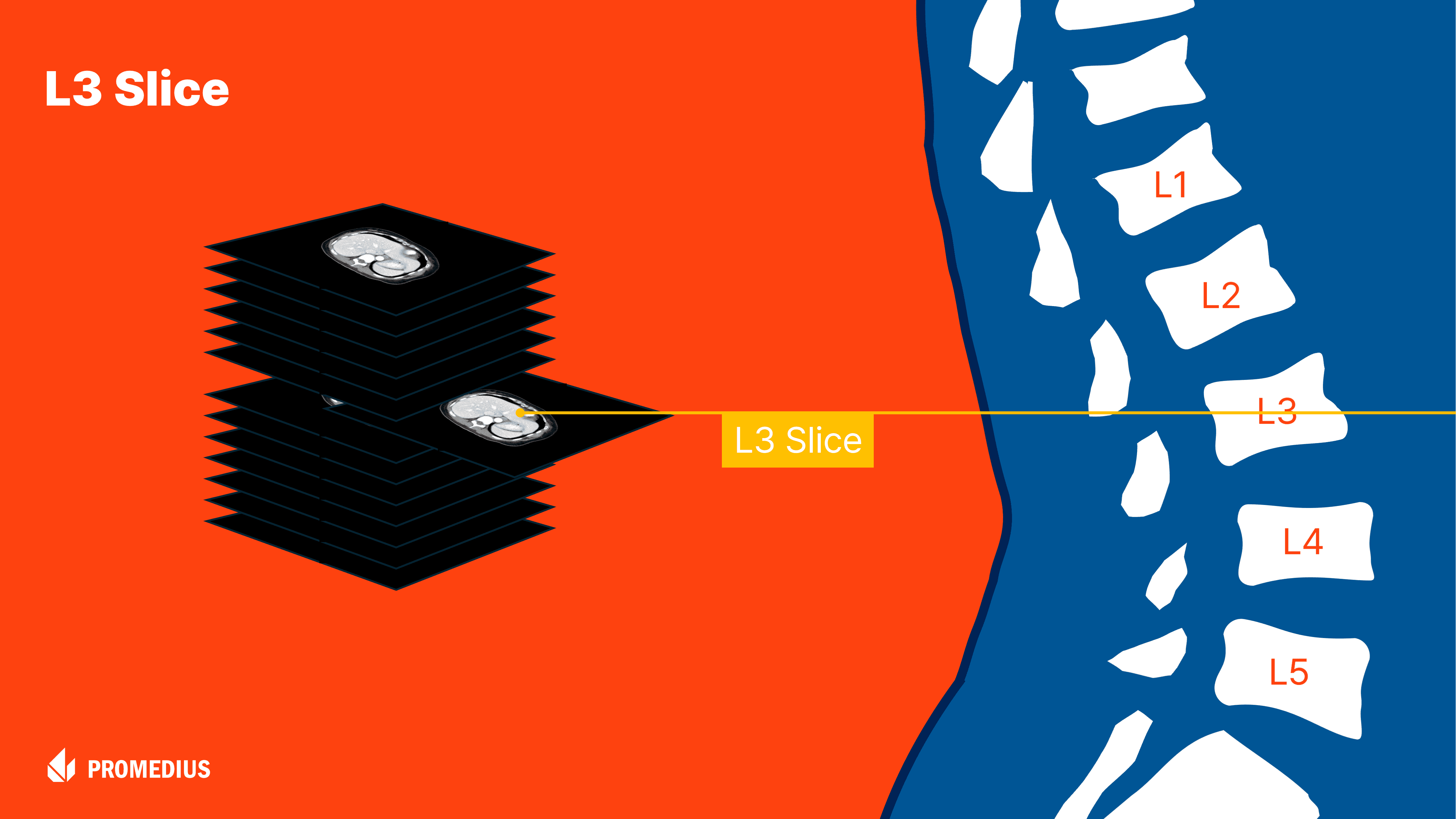 CT로 보는 근육과 지방: L3 단면 분석의 의미 - PROMEDIUS | Healthy Aging through AI