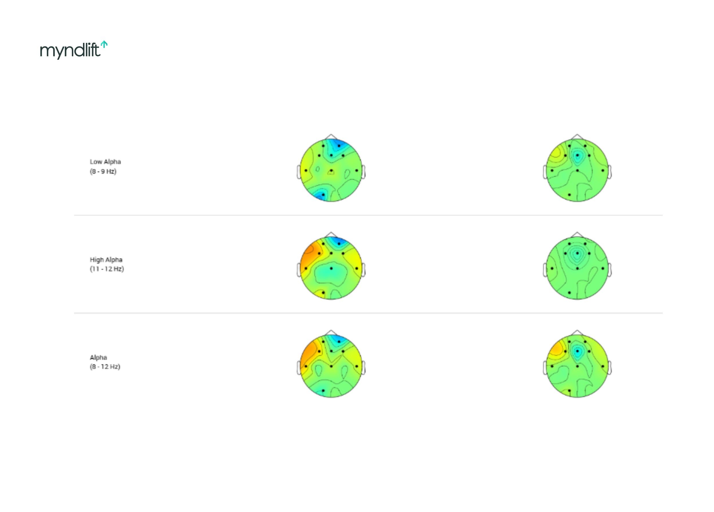 How to Read a qEEG Brain Map: A Practical Guide