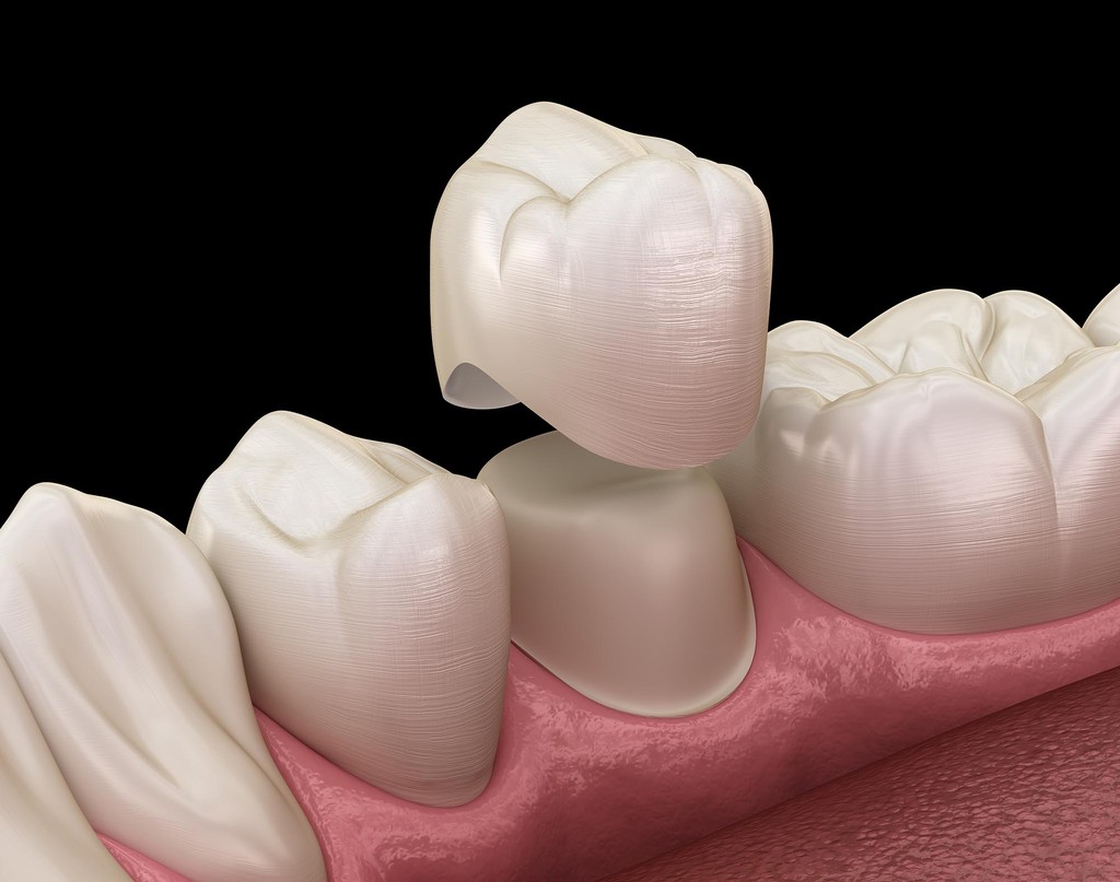 Dental Crowns: Types, Procedures, and Benefits of Teeth Crowns