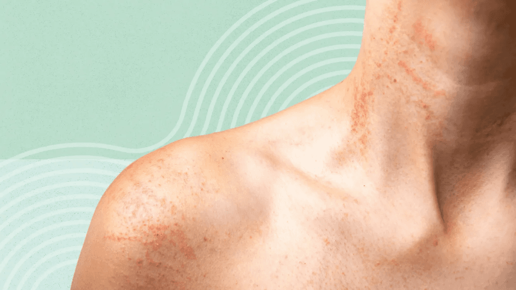 How to Reduce Tirzepatide Rashes and Skin Irritation Safely - MeAgain ⚡ ...
