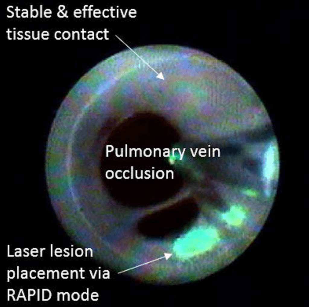Heartlight X3 System
