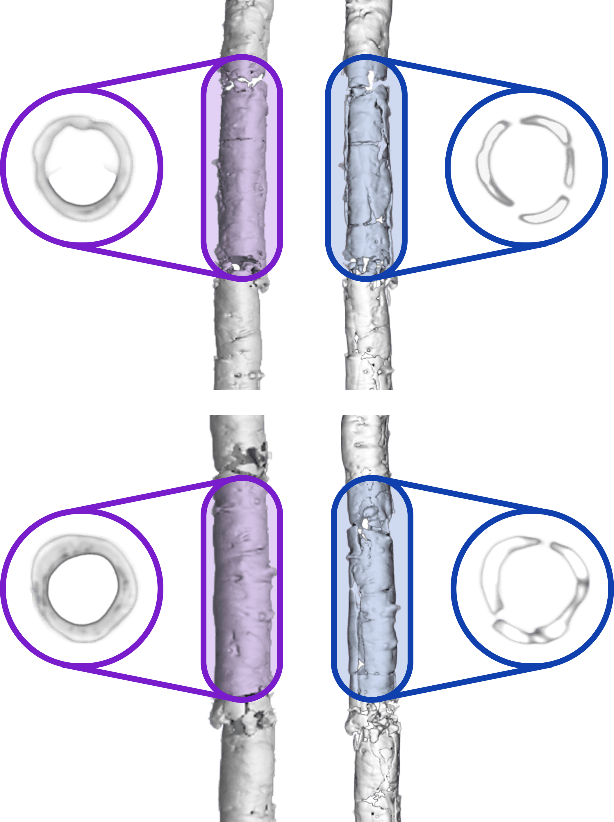 Novel IVL for Coronary Artery Disease | FastWave Medical