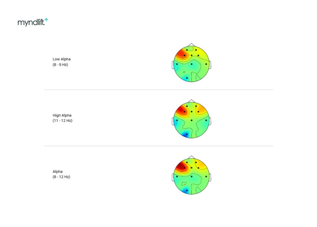 How to Read a qEEG Brain Map: A Practical Guide