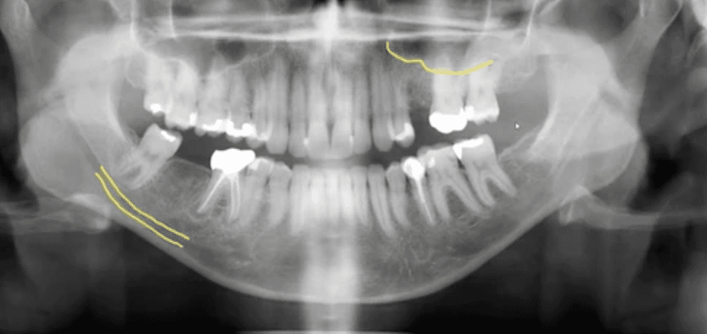 Implant Ninja - We Make Learning Implants Easy