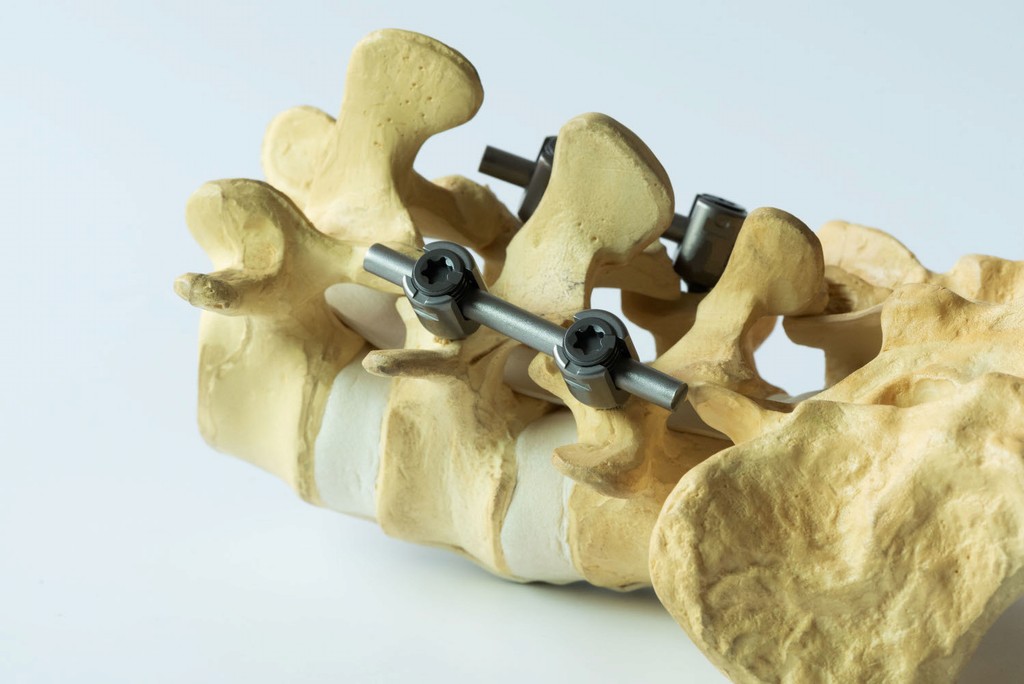 Anterior Cervical Discectomy & Fusion (ACDF) | Auckland Neurosurgery Group