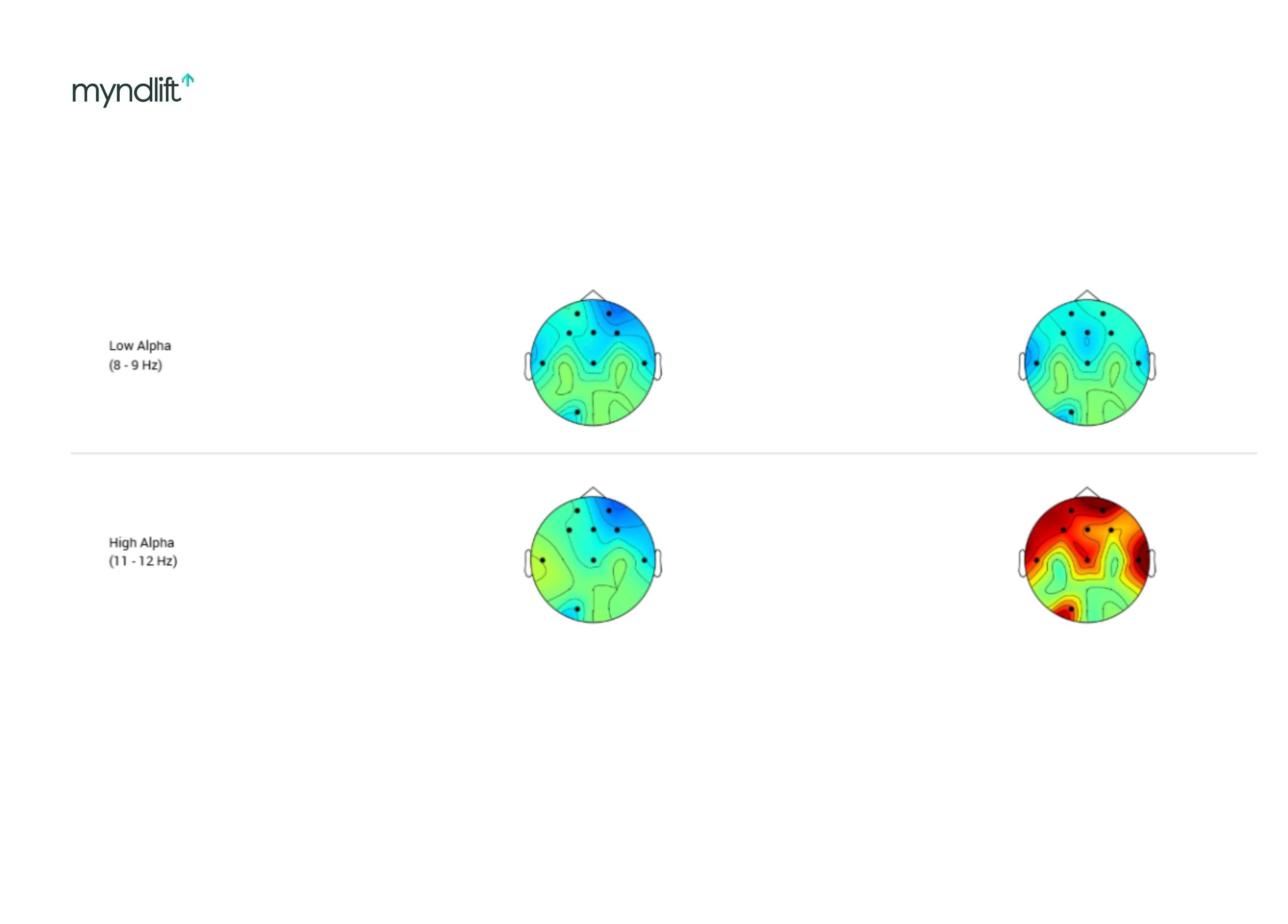 How to Read a qEEG Brain Map: A Practical Guide