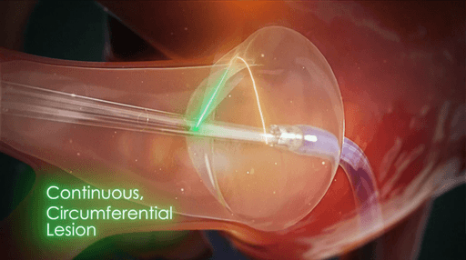 Heartlight X3 System