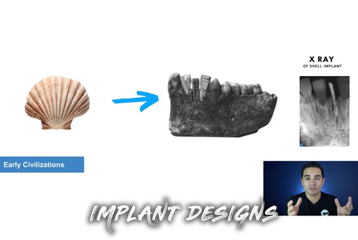 The Implant Track - Implant Ninja