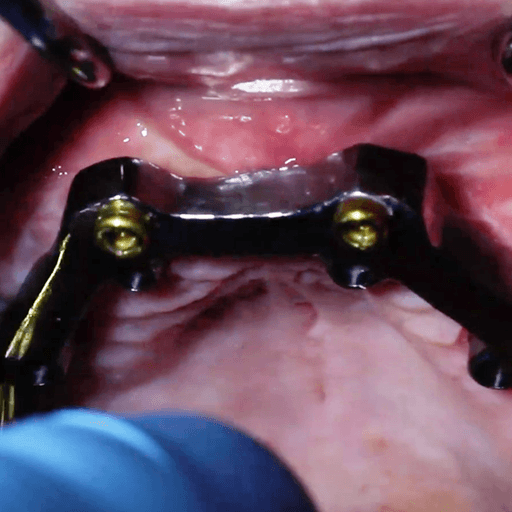 Implant Ninja - We Make Learning Implants Easy