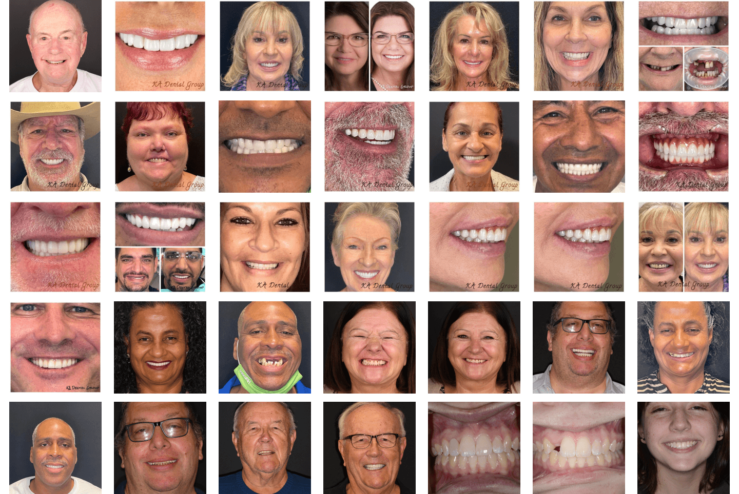 Smile Gallery Ka Dental Cosmetic Dentist In Palm Beach County