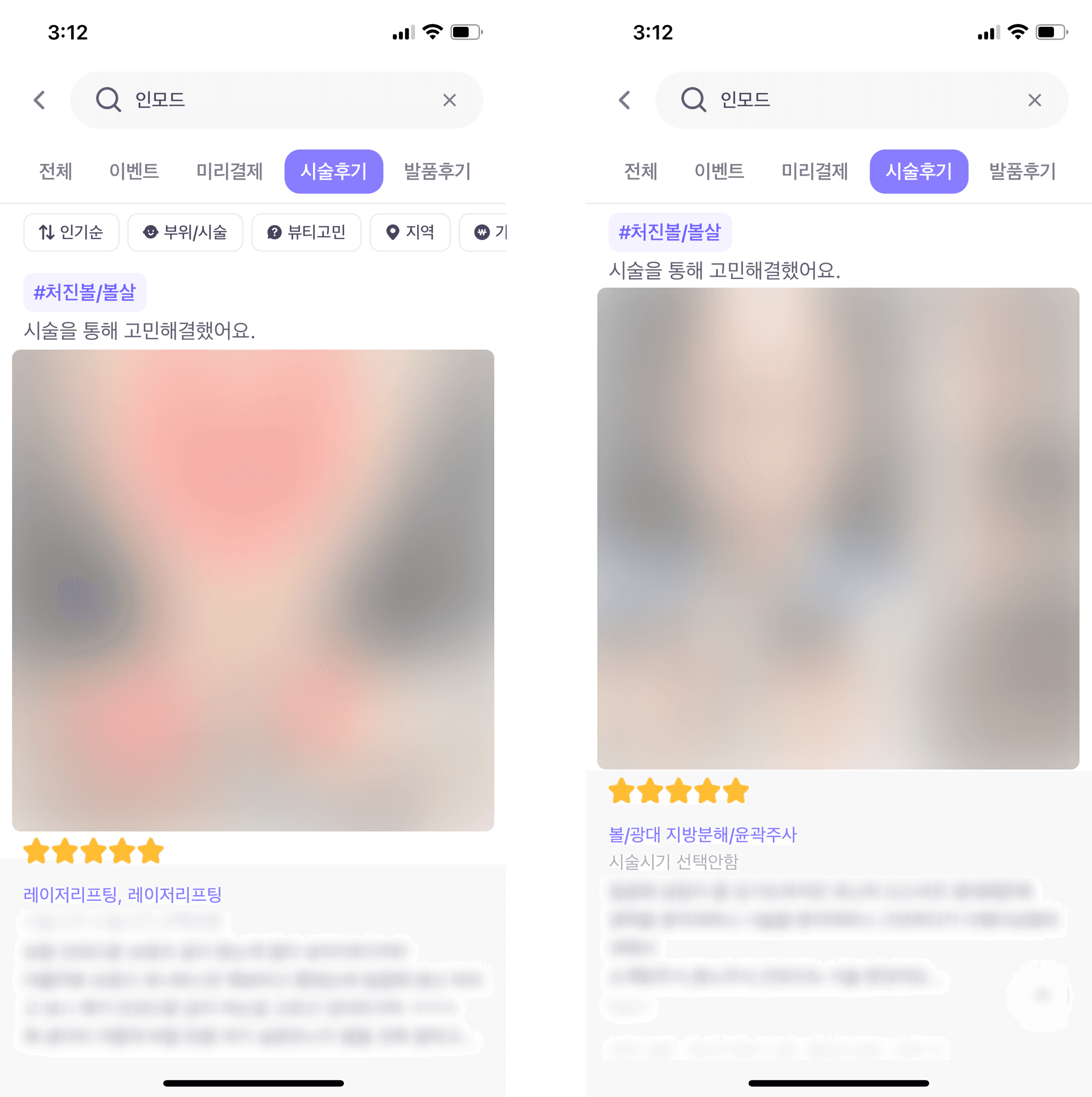 인모드 실제 시술 전후 효과, Forma/FX차이, 가격, 울쎄라/슈링크와의 차이점까지 - 바비톡