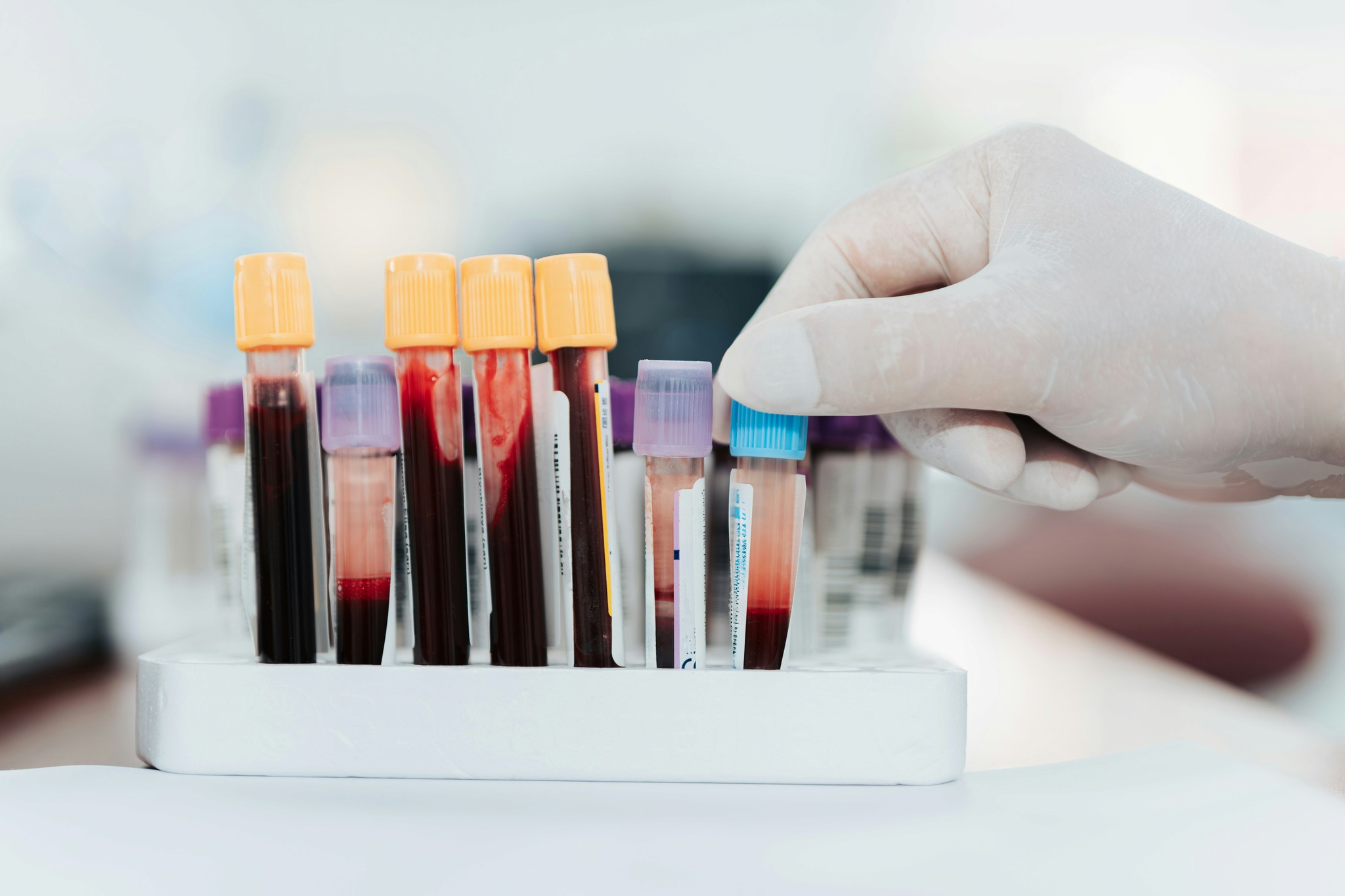 What Do Inflammatory Markers in Blood Tests Mean? - GoodLabs