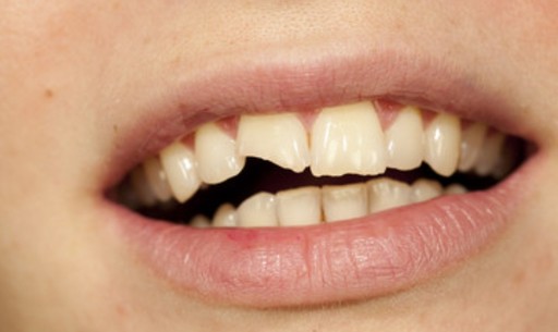 How To Manage Brittle Teeth - Boynton Beach Town Square Dentistry