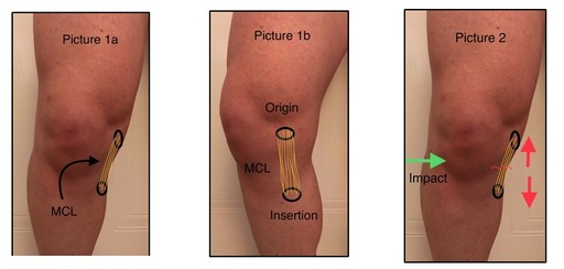 MCL – Medial Collateral Ligament Injury